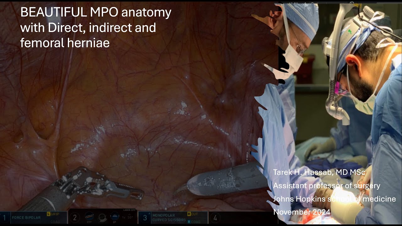 BEAUTIFUL MPO anatomy in robotic bilateral TAPP inguinal/Femoral hernia ...