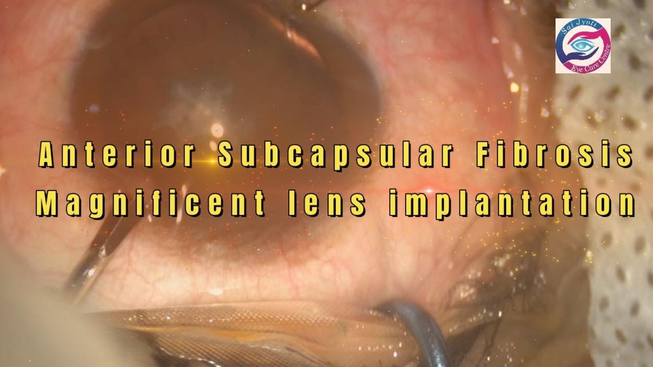 ANTERIOR SUBCAPSULAR CATARACT WITH SUBCAPSULAR FIBROSIS TRAUMATIC WITH ...