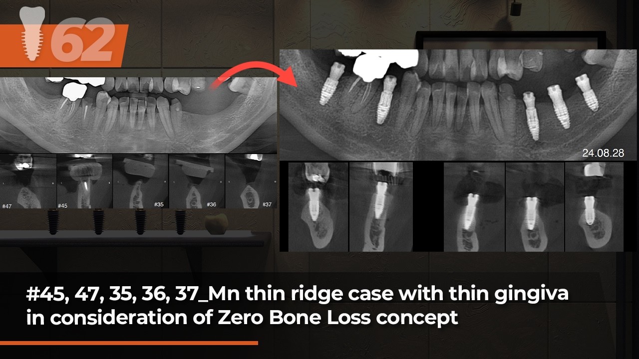 #45, 47, 35, 36, 37 Mn thin ridge case with thin gingiva in ...