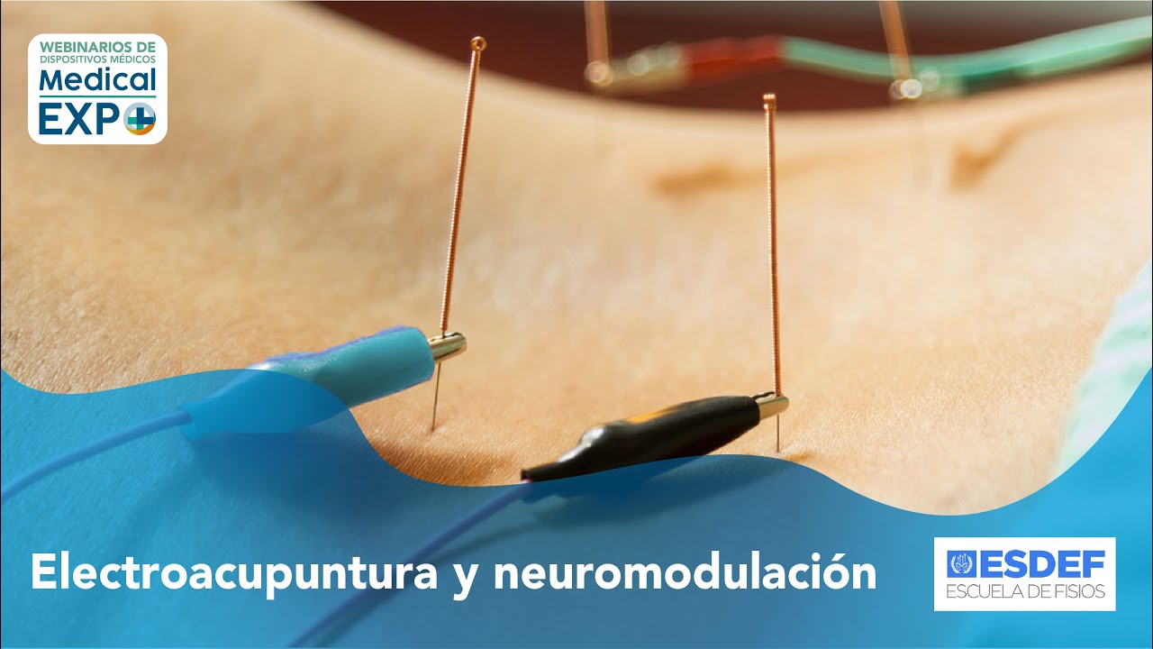 Electroacupuntura Y Neuromodulación Youtube