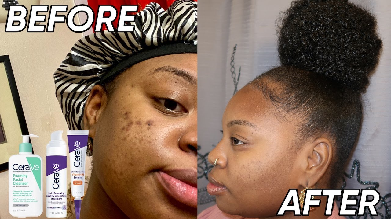 CERAVE SKINCARE PRODUCTS REVIEW #skincare #hyperpigmentation #acne # ...