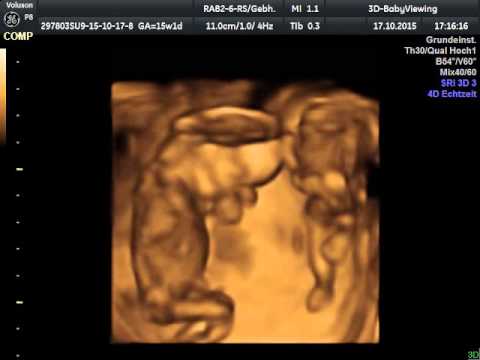 3D-baby Ultraschall, 4D-Baby Ultraschall, 3D/4D Ultraschall Baby ...