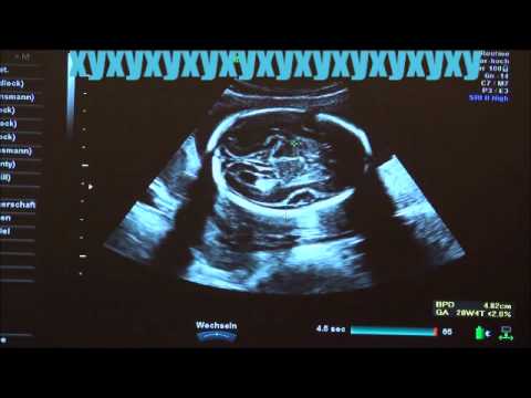 Ultraschall 2D und 4D in der 22+6 SSW - YouTube