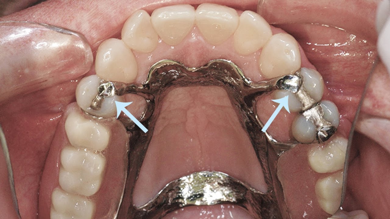 Prótese Removível Com Grampo Superior - RETOEDU
