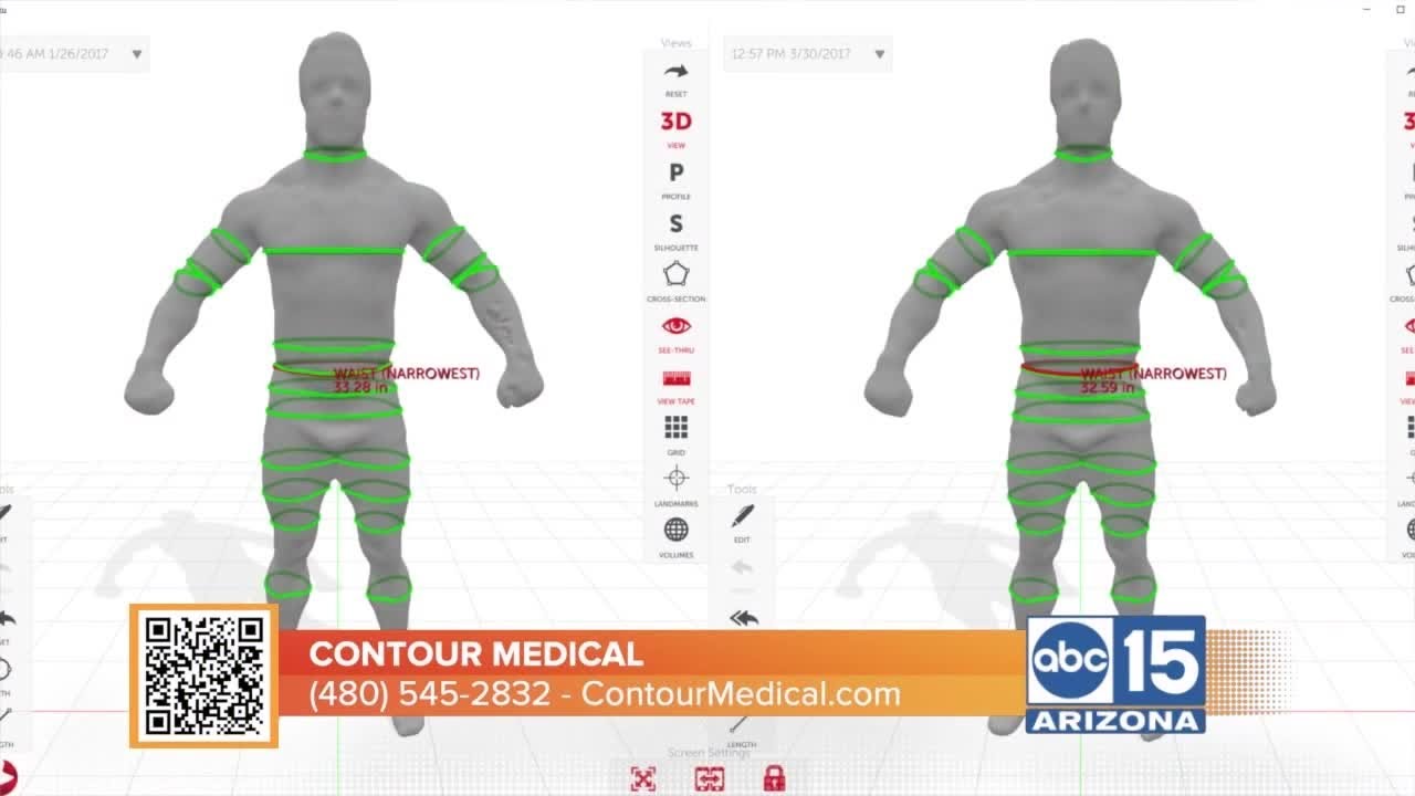 Contour Medical can help you get your summer body ready - YouTube