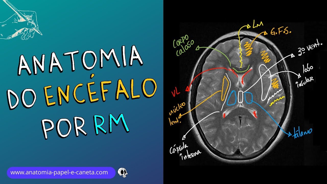 Anatomia Do EncÉfalo Por Rm Dicas De Como Localizar As Estruturas No Exame Youtube