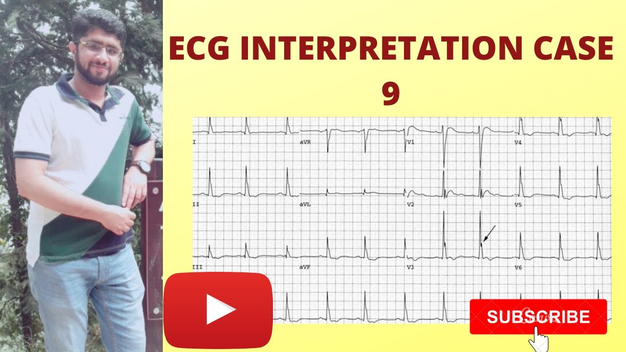 ECG INTERPRETATION CASE 9| EKG | ELECTROCARDIOGRAM - YouTube