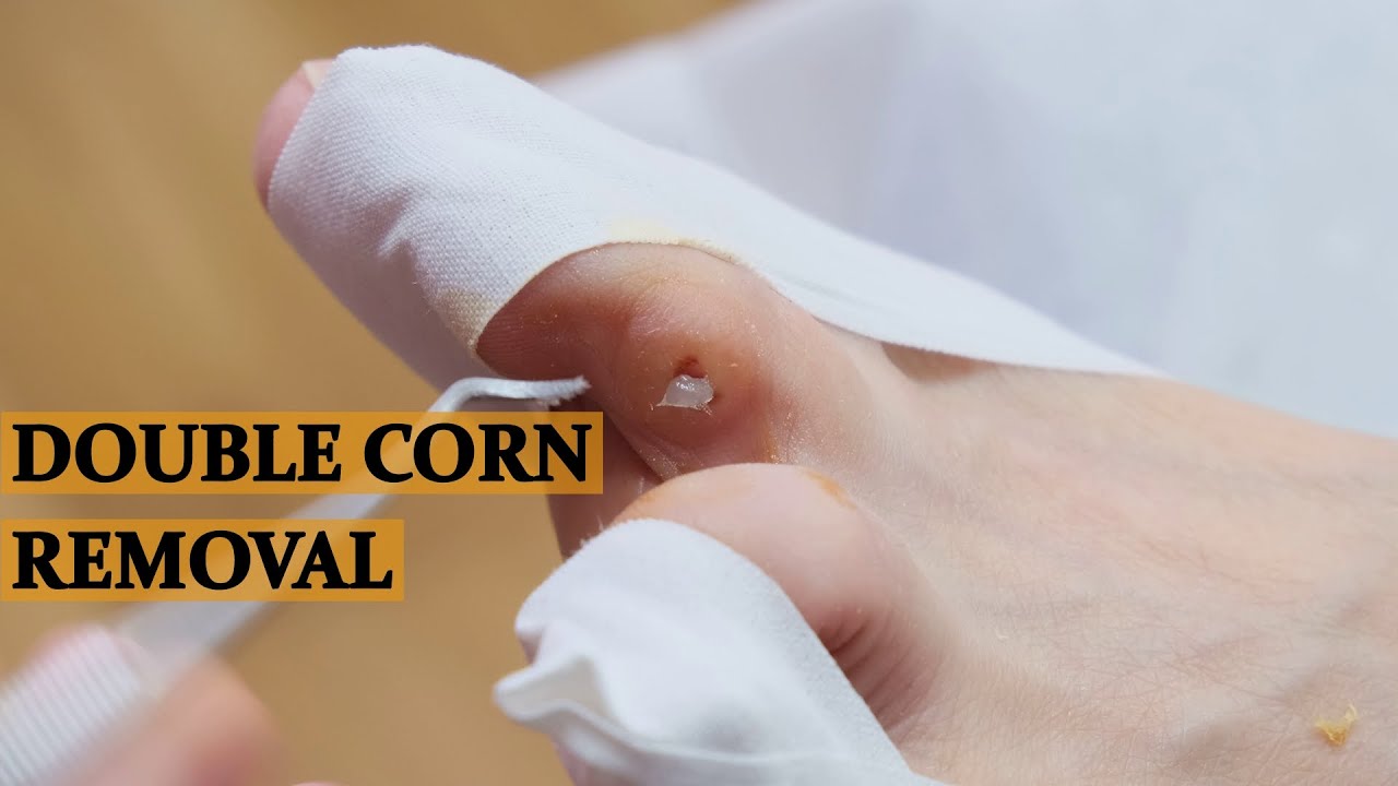 DEEP SATISFYING CORN REMOVAL. - YouTube