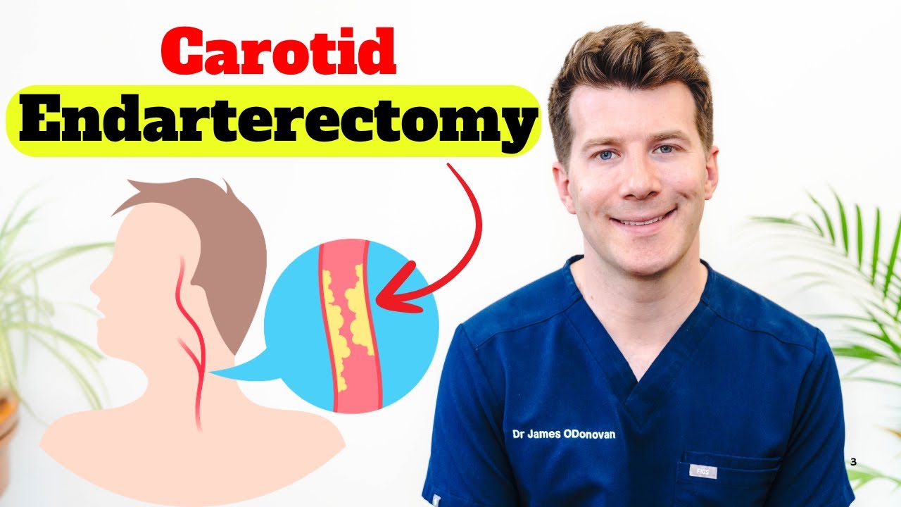 Doctor explains Carotid Endarterectomy | Procedure, benefits, risks and ...