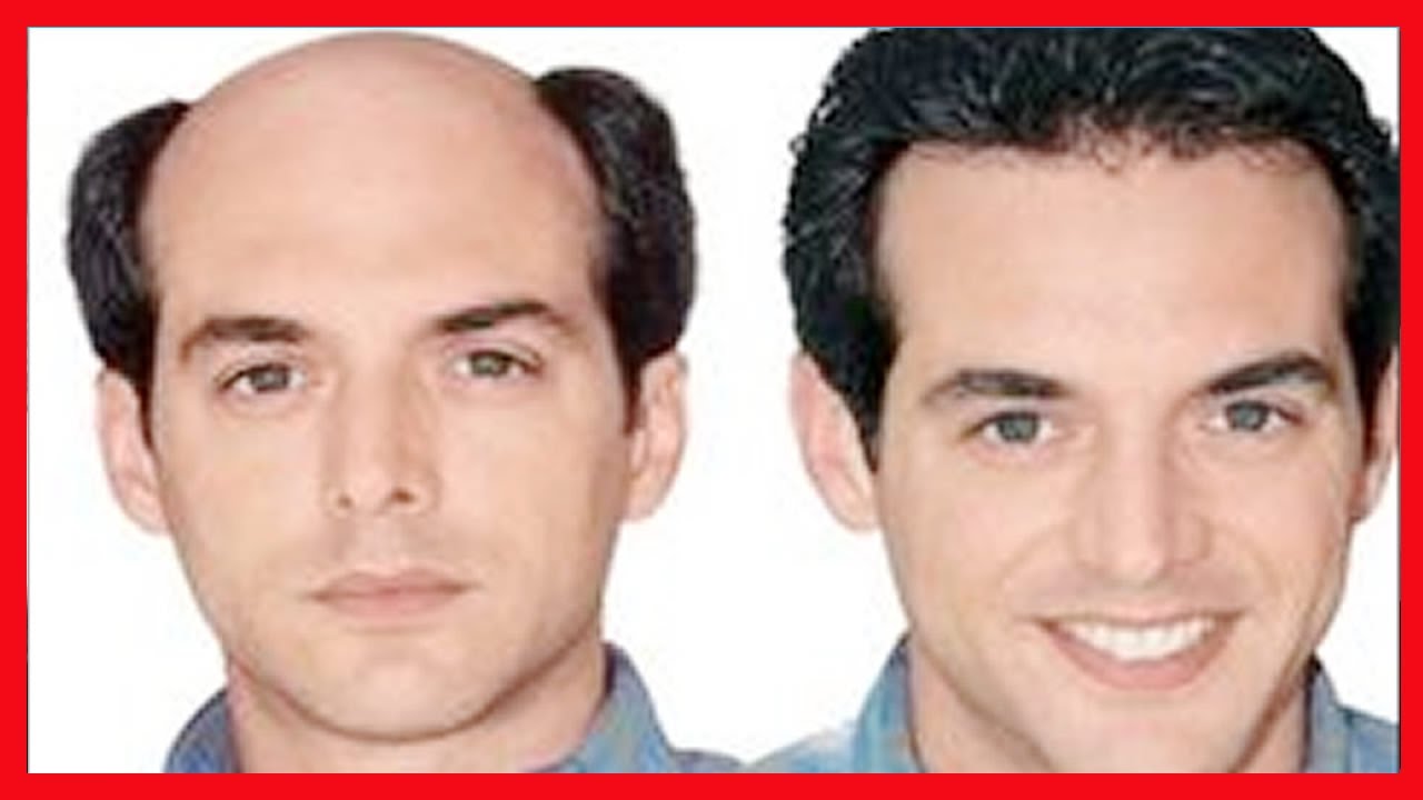 CALVICE 10 Dicas Para Acabar Com a Queda de Cabelo - CALVICE TEM CURA ...