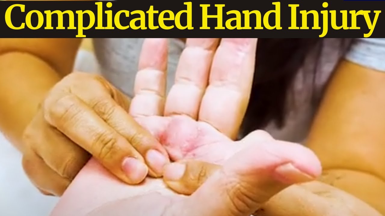 Tackling A Complicated Hand Injury & Finger Amputation & Fracture - YouTube