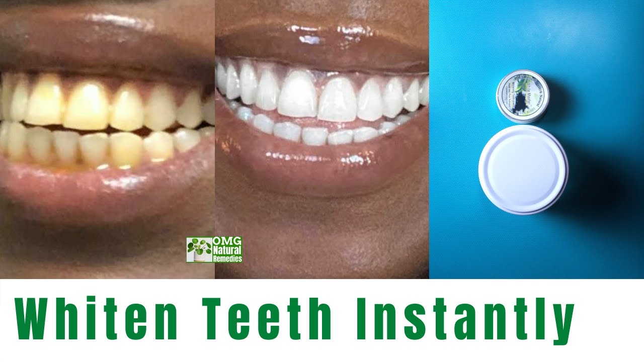 Get instant white teeth in 2 minutes II How to whiten teeth at Home ...