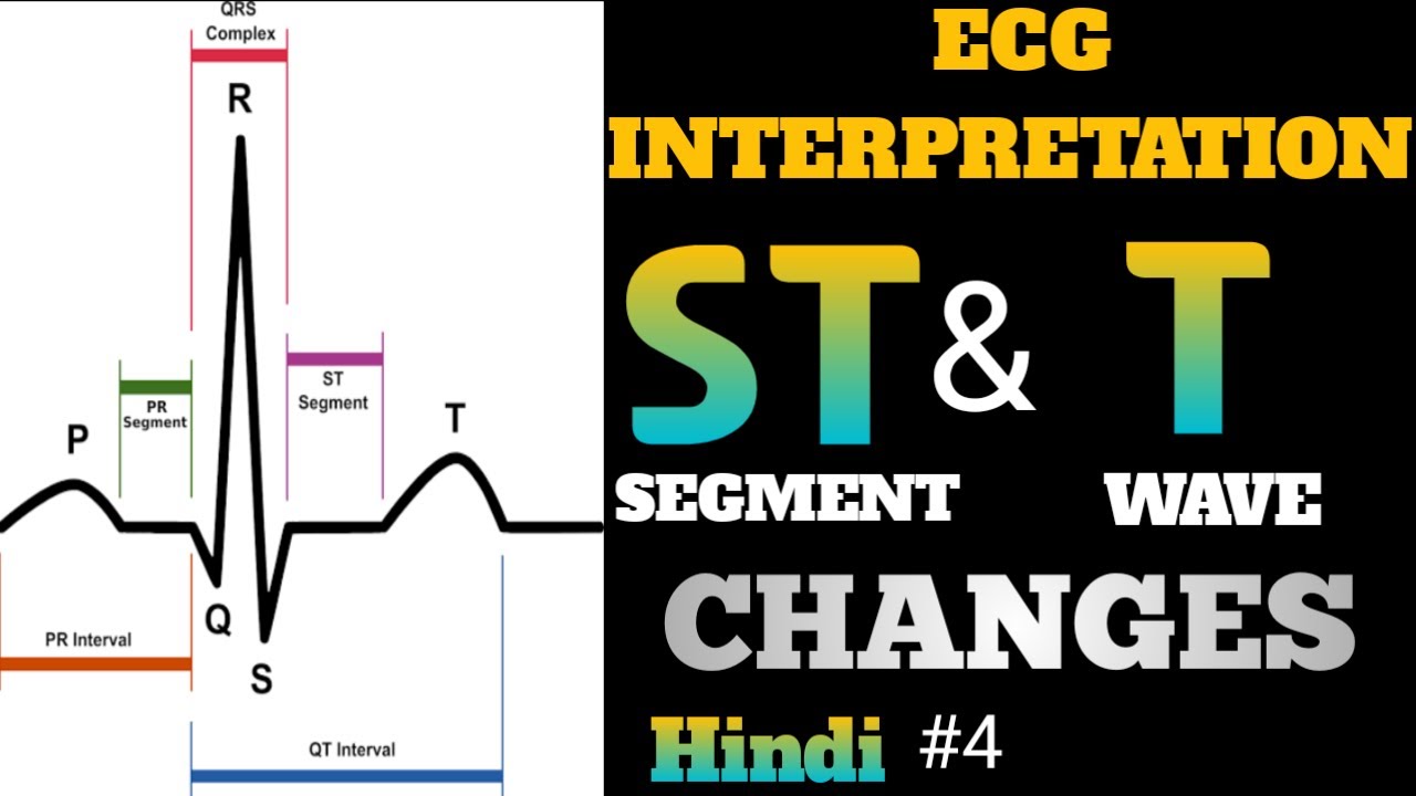 ECG interpretation in hindi | how to read ecg in hindi | ST and T Wave ...