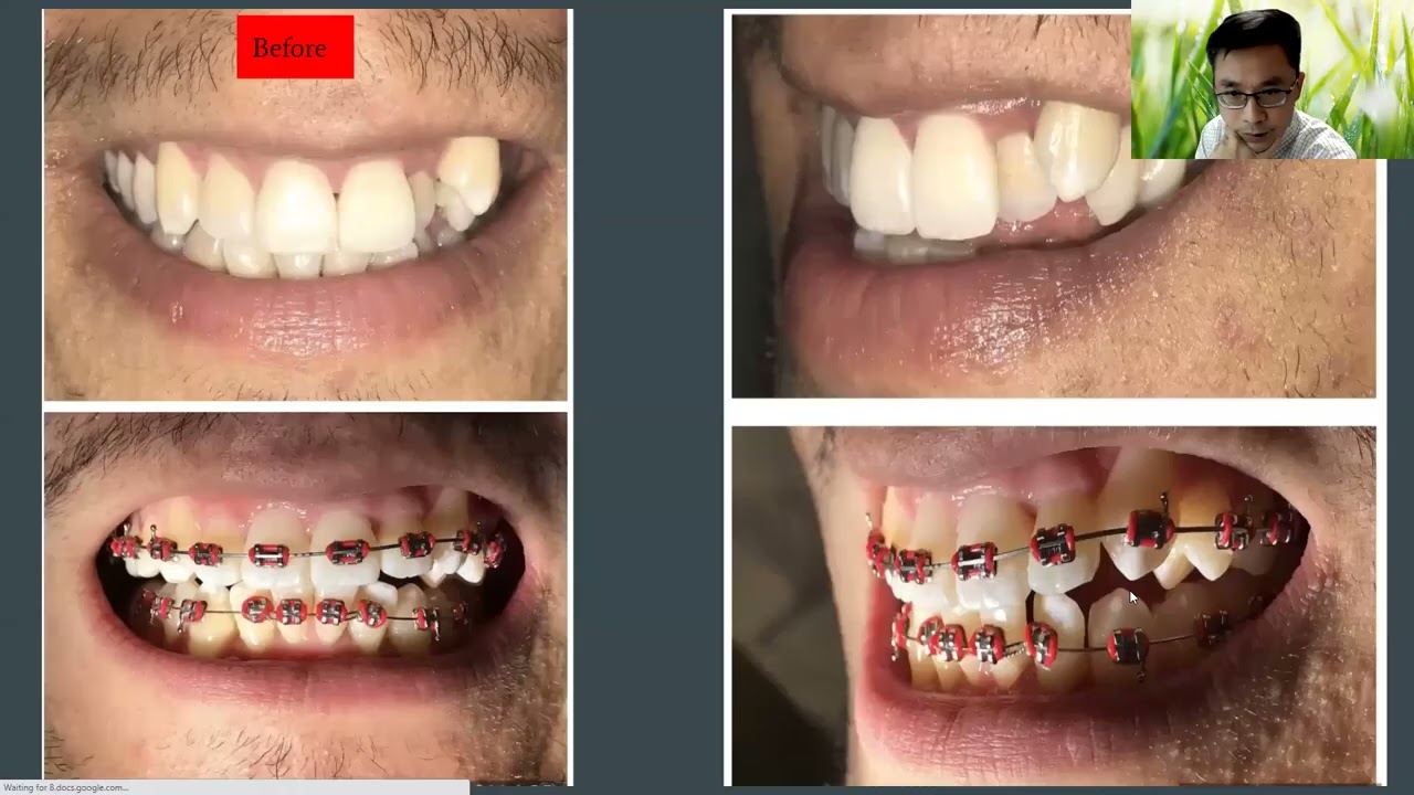 How To Manage Upper and Lower Narrow Arch, Crowded Teeth, Cross Bite ...