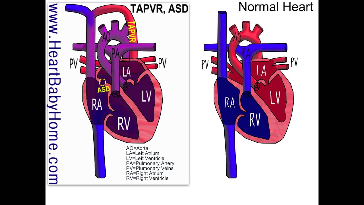 Heart Defect #31 Total Anomalous Pulmonary Vein Return with ASD - YouTube