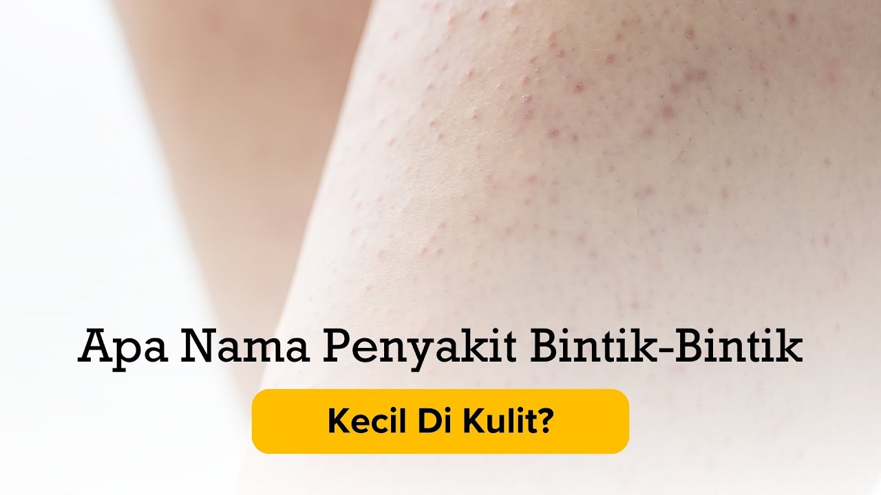 Apa Nama Penyakit Bintik - Bintik Kecil Di Kulit? - YouTube