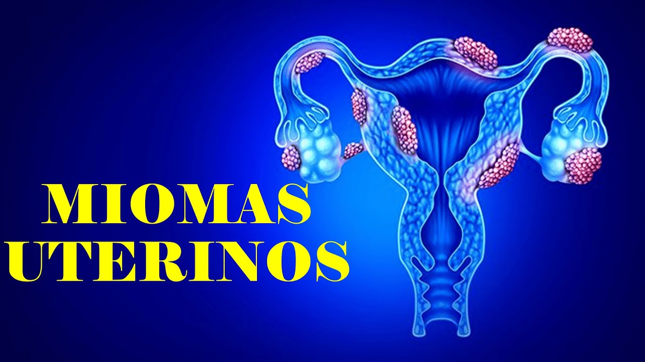 MIOMAS UTERINOS: ¿QUÉ ES? CAUSAS, SÍNTOMAS, DIAGNÓSTICO Y TRATAMIENTO ...