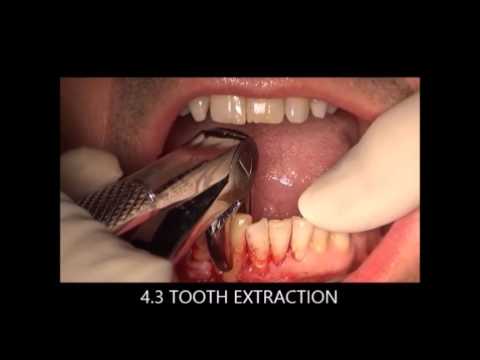 MIS 4BONE: VERTICAL GBR IN ATROPHIC JAW - YouTube