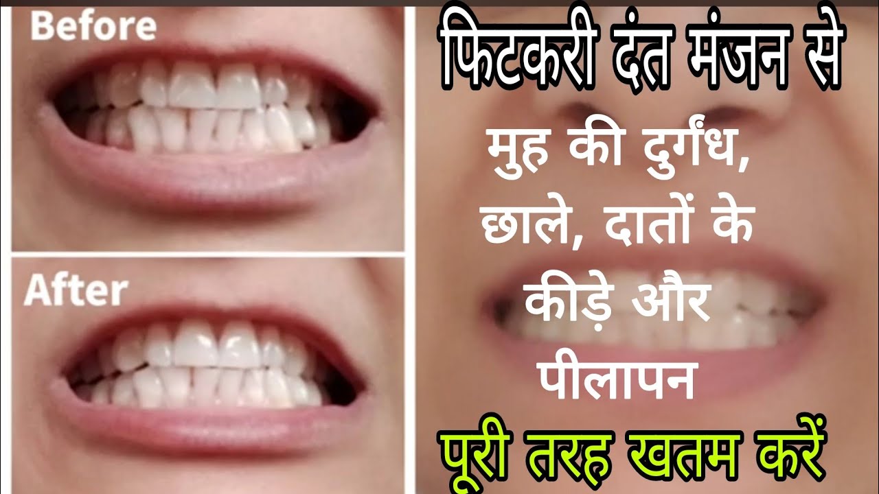 Alum/Fitkari Tooth Powder for Oral health | मसूड़ों मे सड़न, मुह की ...
