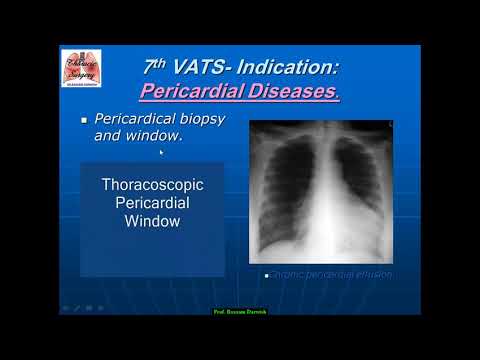 VATS in the Respiratory Diseases - YouTube