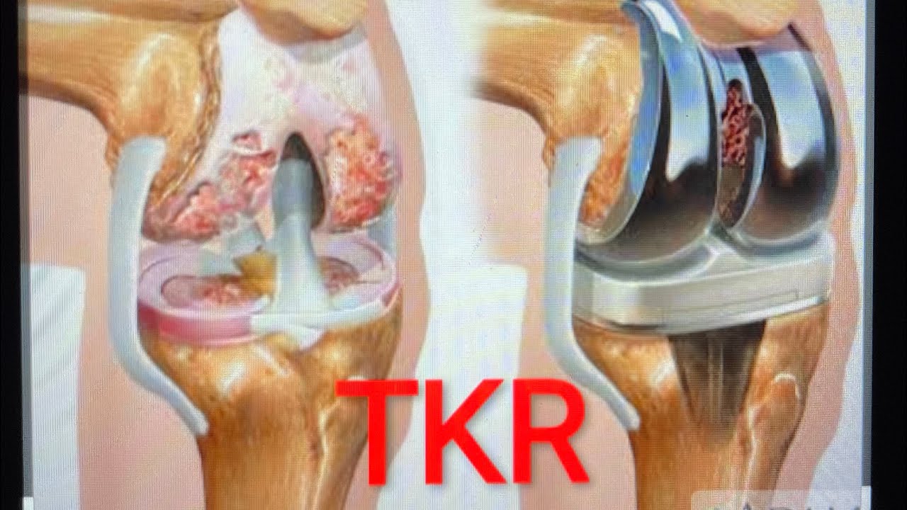 TKR | Knee Replacement Surgery | How a patient Can Decide Best TKR Surgery @himvedaphysiotherapy ...