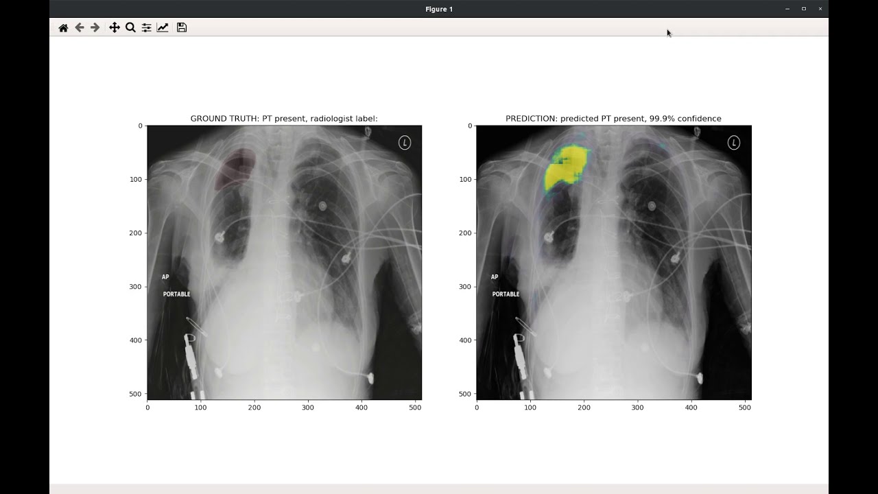 My Unet Implementation Pneumothorax Classification And Segmentation