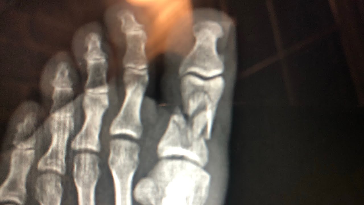 Toe Surgery For Broken Toe - YouTube