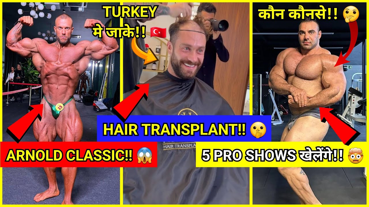 (हिंदी) CHRIS BUMSTEAD HAIR TRANSPLANT + ROELLY WINKLER CURRENT ...