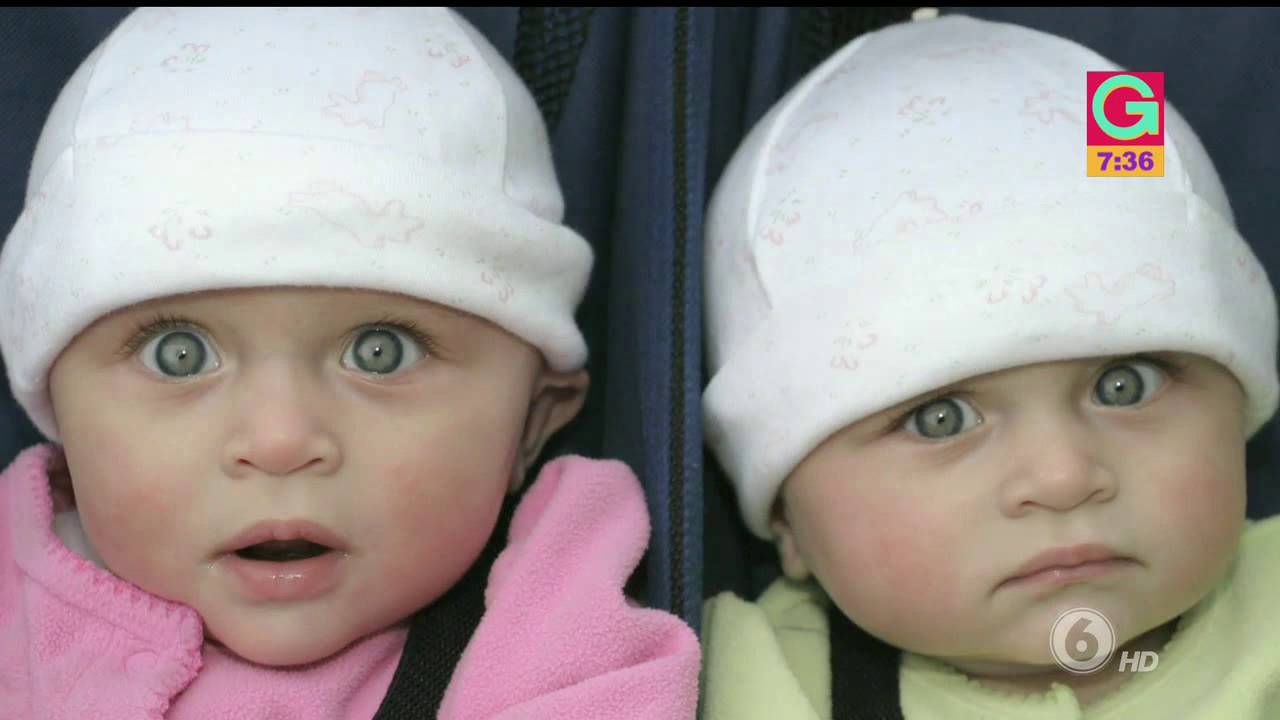 Los gemelos podrán ser operados en el Calderón Guardia antes de nacer ...