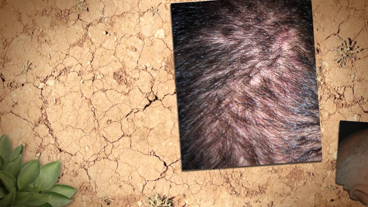 Bumps On Scalp YouTube bumps-on-scalp-youtube