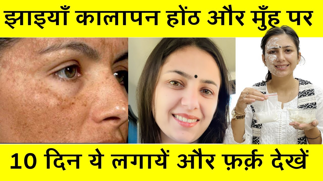 10 Days Challenge For Pigmentation Melasma Dark Spots Around Mouth 10-days-challenge-for-pigmentation-melasma-dark-spots-around-mouth