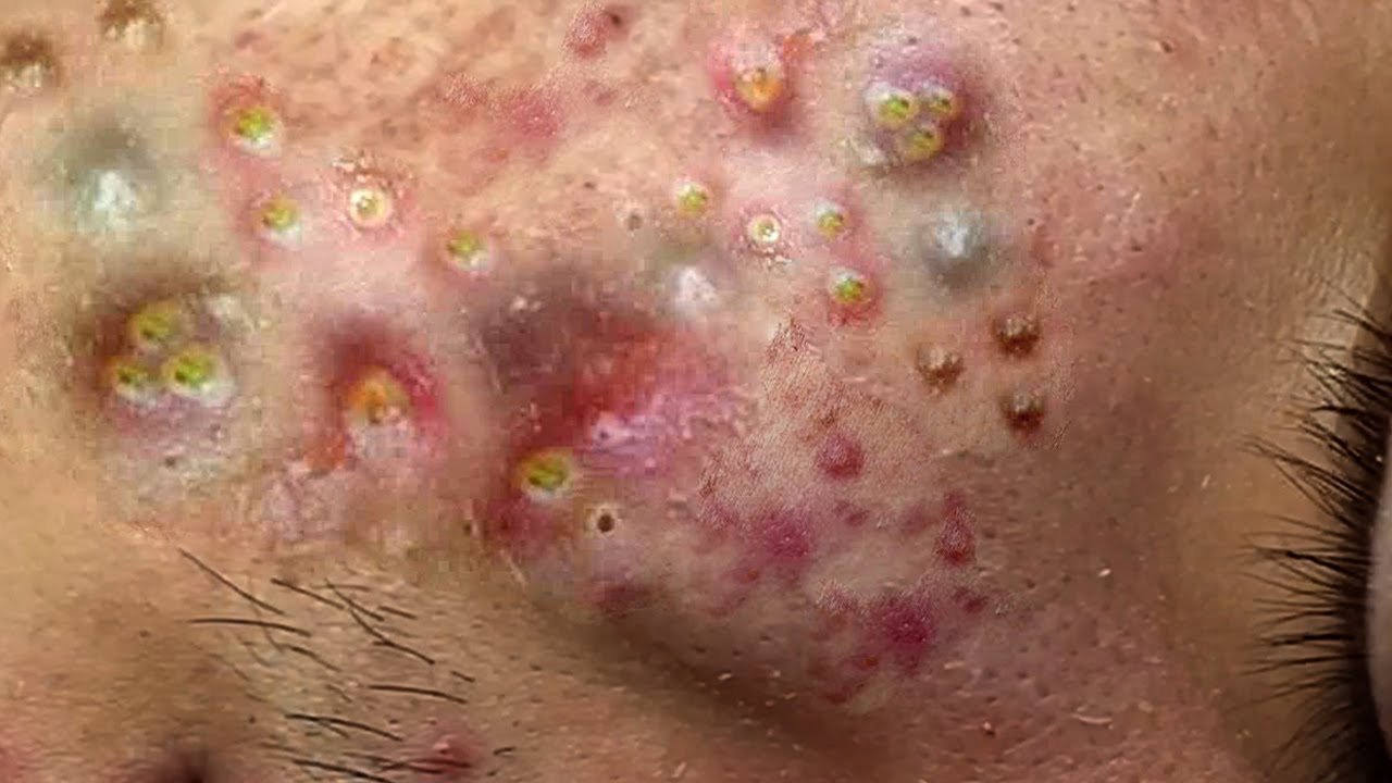 𝐏𝐚𝐢𝐧𝐬𝐭𝐚𝐤𝐢𝐧𝐠 𝐒𝐮𝐩𝐞𝐫 𝐒𝐚𝐭𝐢𝐬𝐟𝐲𝐢𝐧𝐠 𝐏𝐢𝐦𝐩𝐥𝐞 𝐏𝐨𝐩𝐩𝐢𝐧𝐠 #5066 - YouTube