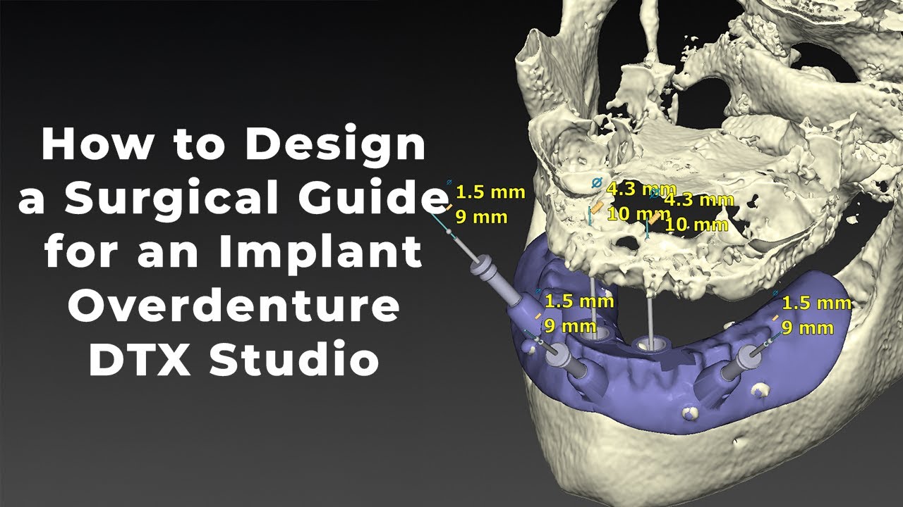 Planning and Designing a Surgical Guide for an Implant Overdenture in ...