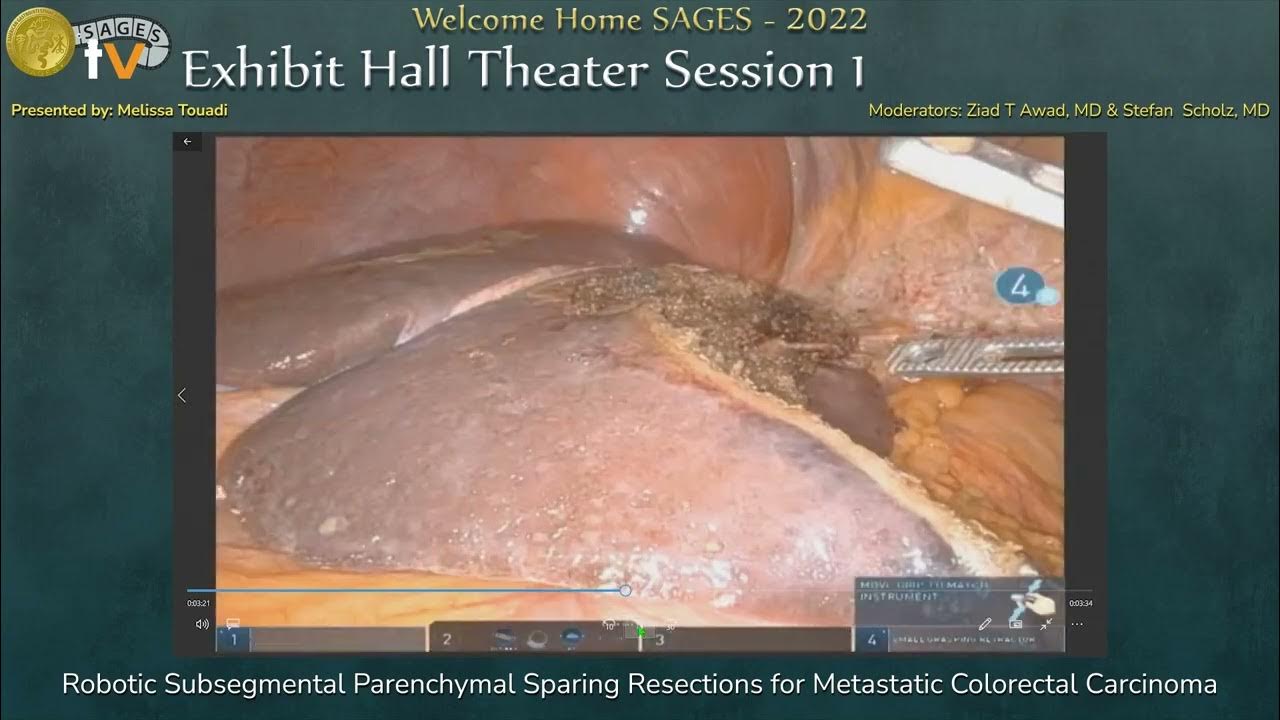 Robotic Subsegmental Parenchymal Sparing Resections For Metastatic Colorectal Carcinoma Youtube
