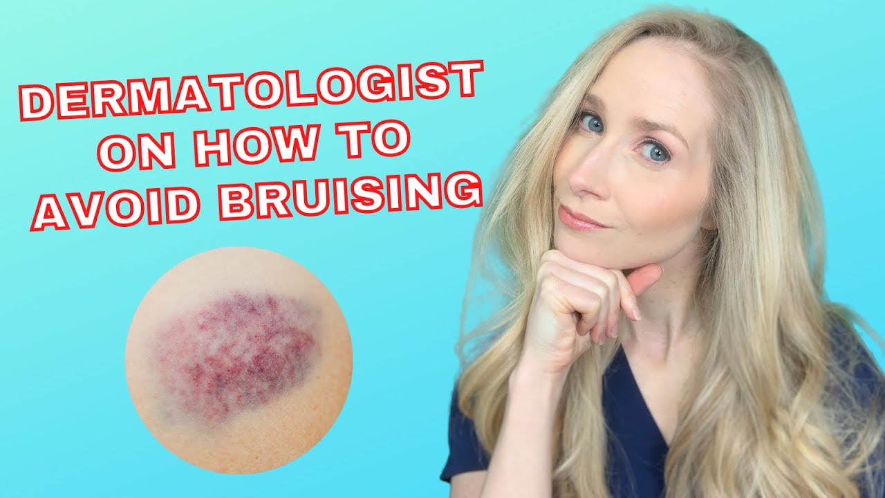 Dermatologist's pro tips on how to prevent and heal bruises - YouTube