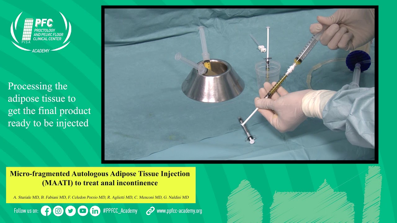 Micro-fragmented Autologous Adipose Tissue Injection (MAATI) to treat ...