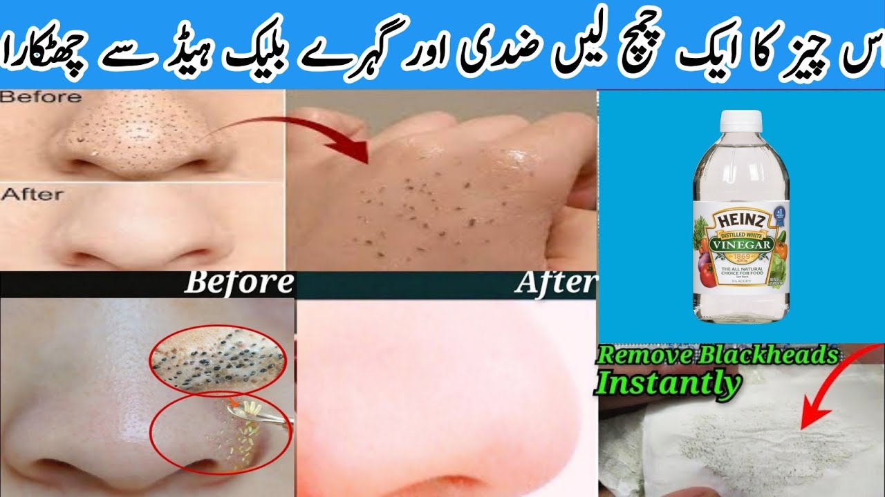 How To Pick Whiteheads Permanently – MTSIVC