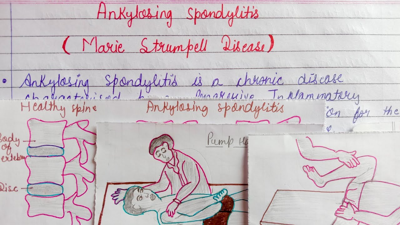 Ankylosing spondylitis (Marie strumpell disease) - YouTube