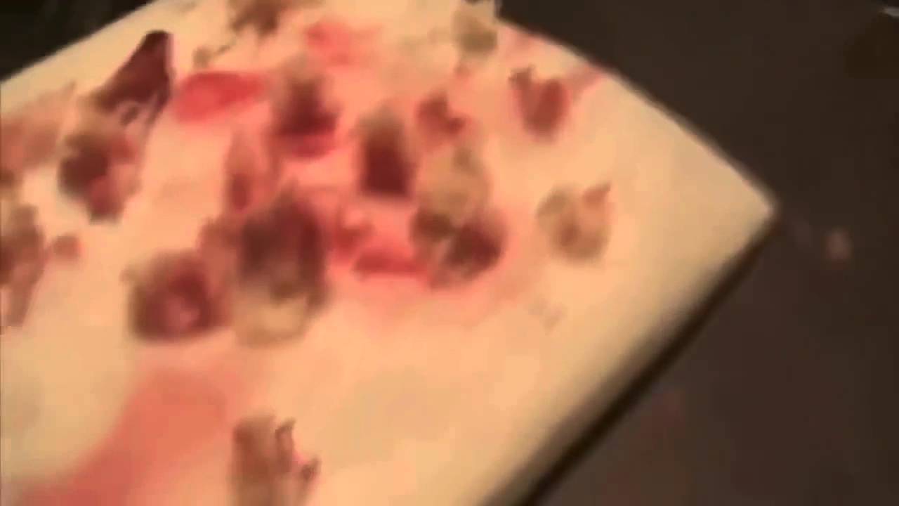 Greatest Blackhead and Whitehead Removal Techniques; Cysts, Popping ...