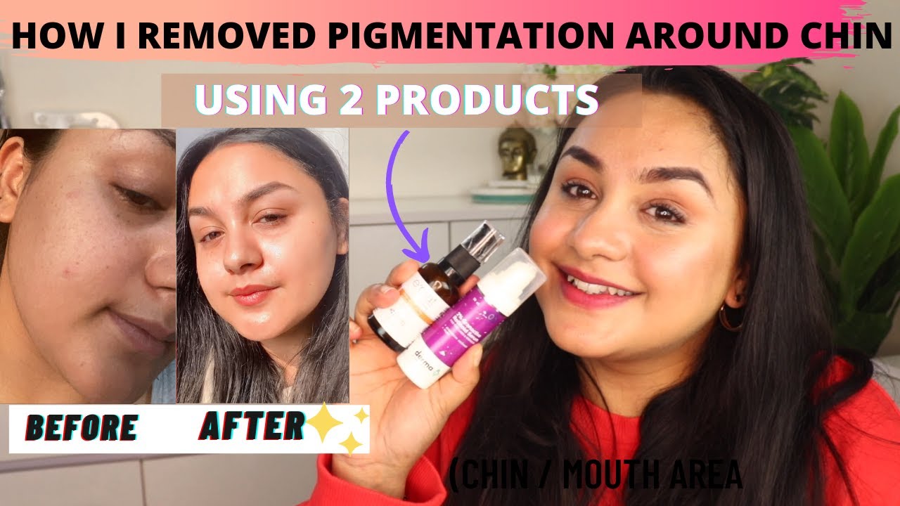 How I Reduced Pigmentation Around My Chin/Mouth By Using Only 2 ...