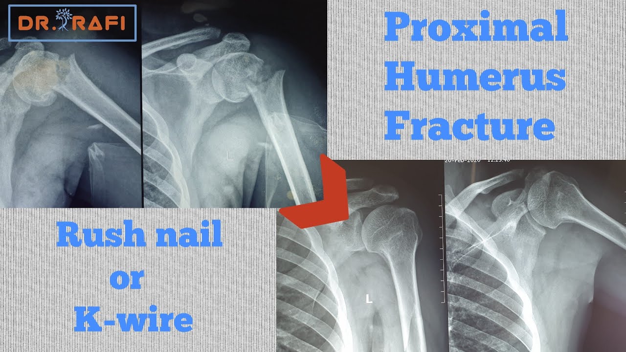 Proximal Humerus Fracture management : Rush nail vs K-wire (Bangla ...