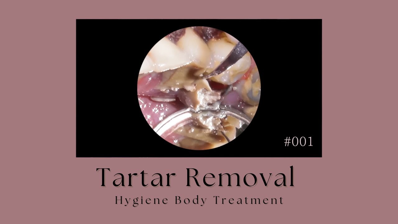 Tartar Removal 001 - YouTube