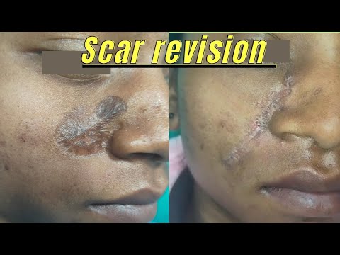 Big scar on cheek - change after scar revision| Scar revision surgery ...