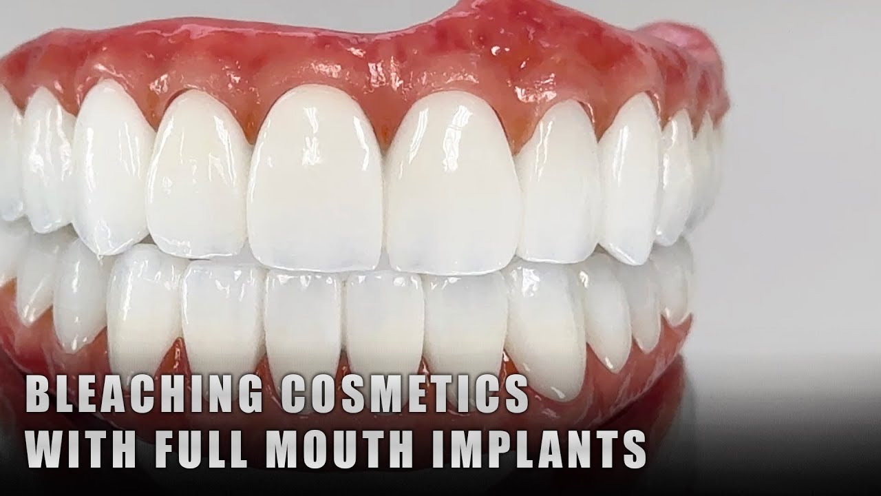 Bleaching Cosmetics with Full Mouth Implants - YouTube