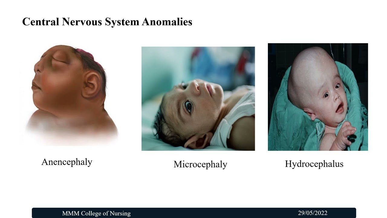 Congenital Anomalies In Children YouTube Congenital Anomalies In Children YouTube