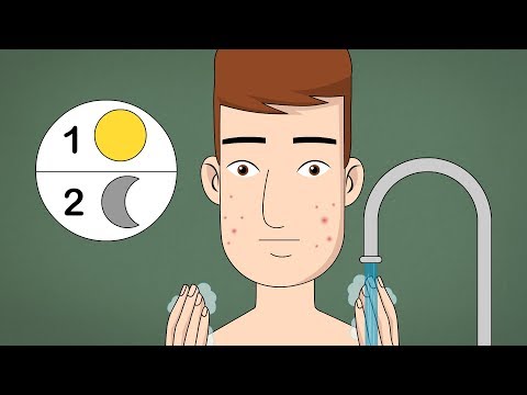 How to Get Rid of Acne (Teen Boys)