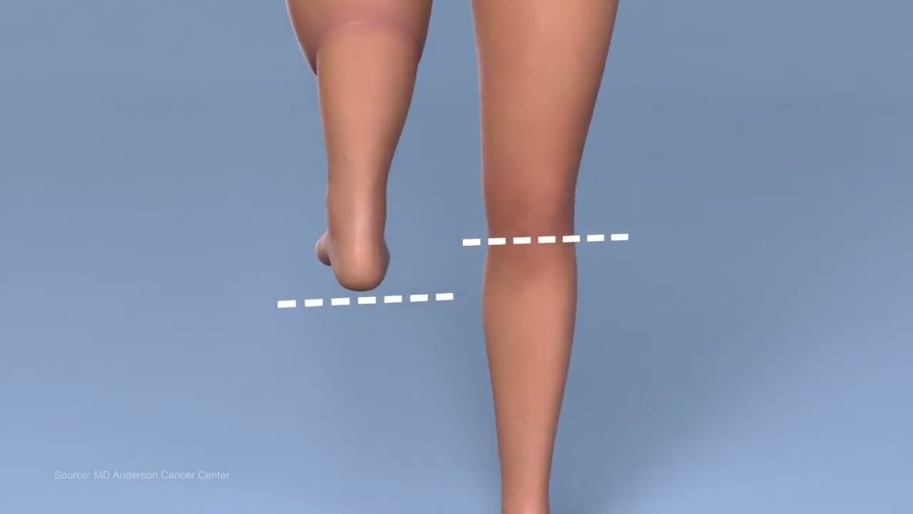 🦵Rotationplasty - YouTube