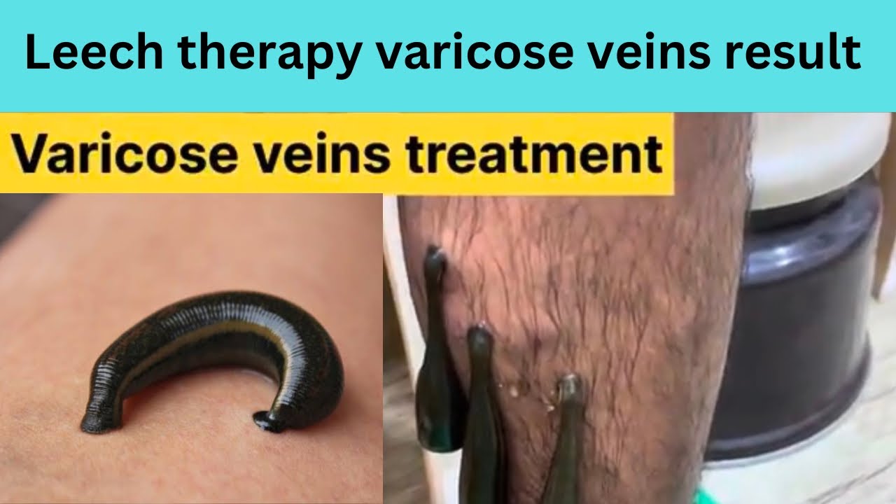 Kzhijama & Leech Therapy Centre Mumbai ( VARICOSE VEINS TREATMENT FOR LEECH THERAPY ) #kzhijama ...