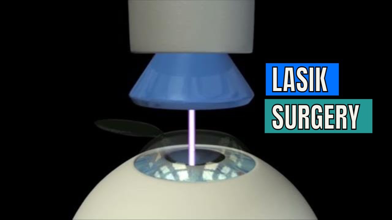 What is Lasik Surgery & how its performed? - YouTube