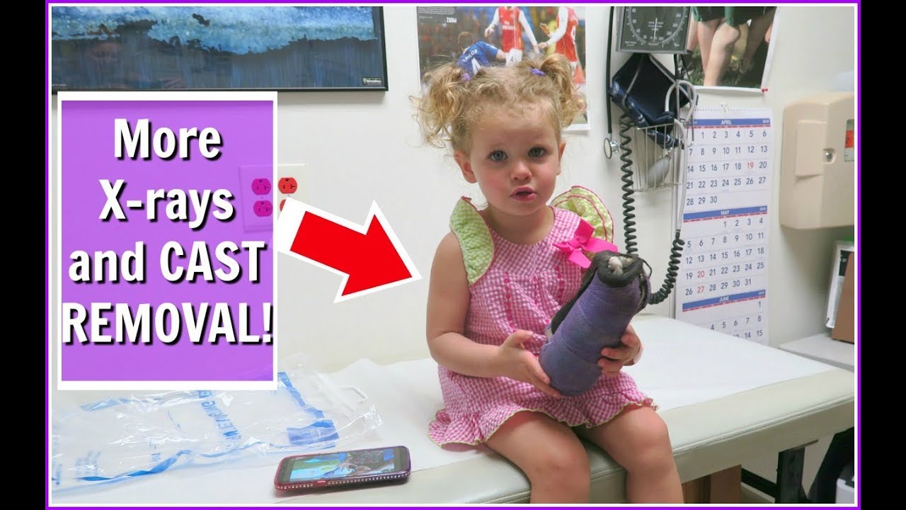 BROKEN ARM: Getting her cast off! Plus more x-rays. - YouTube